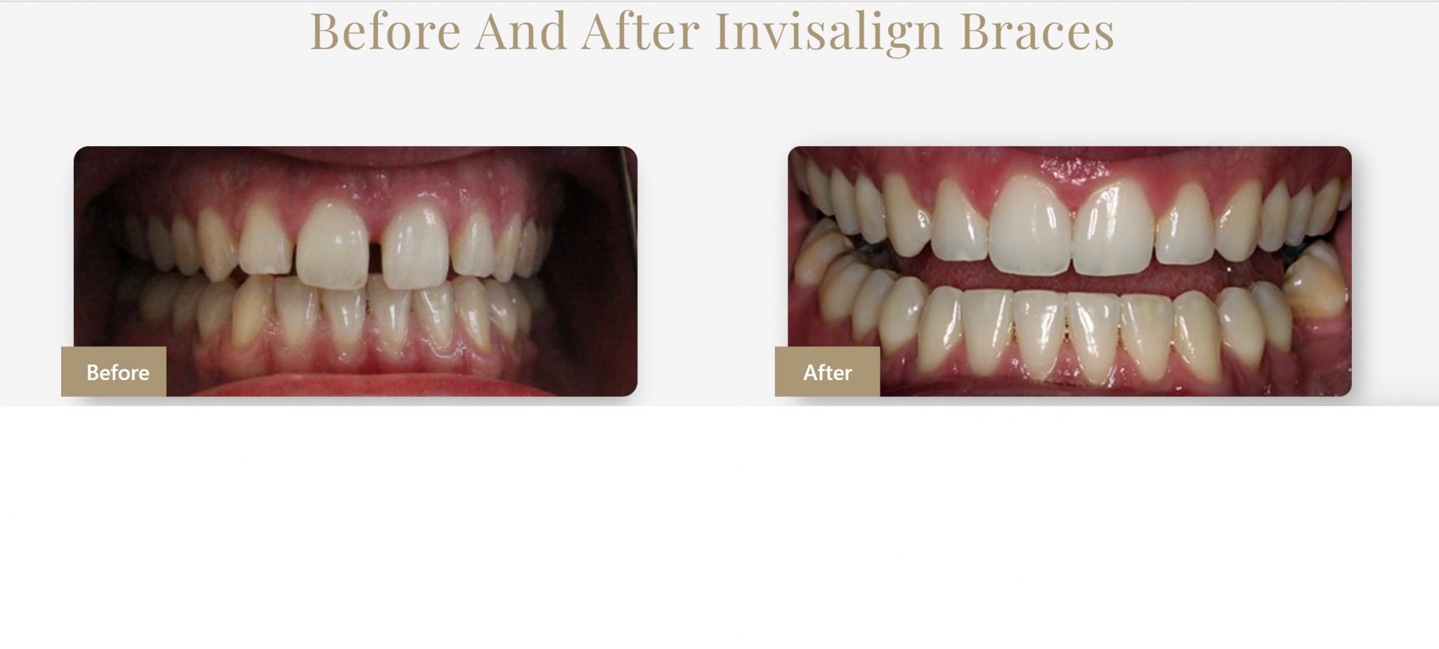 Invisalign | Boston Dental Centre